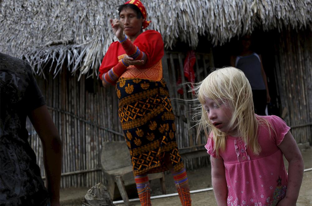 Albinismus: Die Kinder des Mondes | ZEIT ONLINE